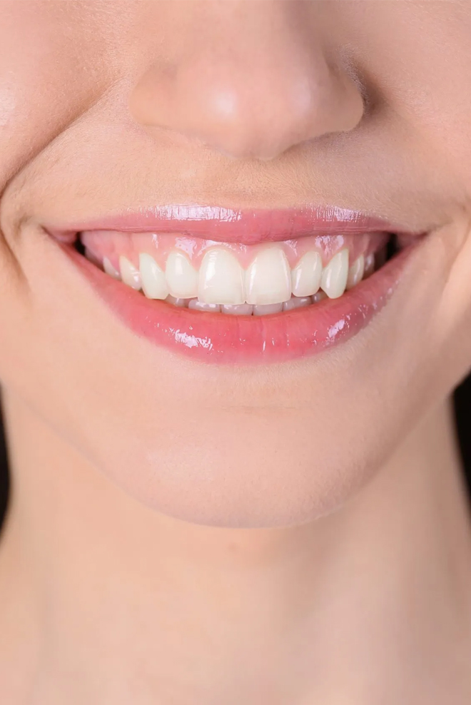 Gummy Smile Treatment in Islamabad – Achieve a Balanced, Confident ...